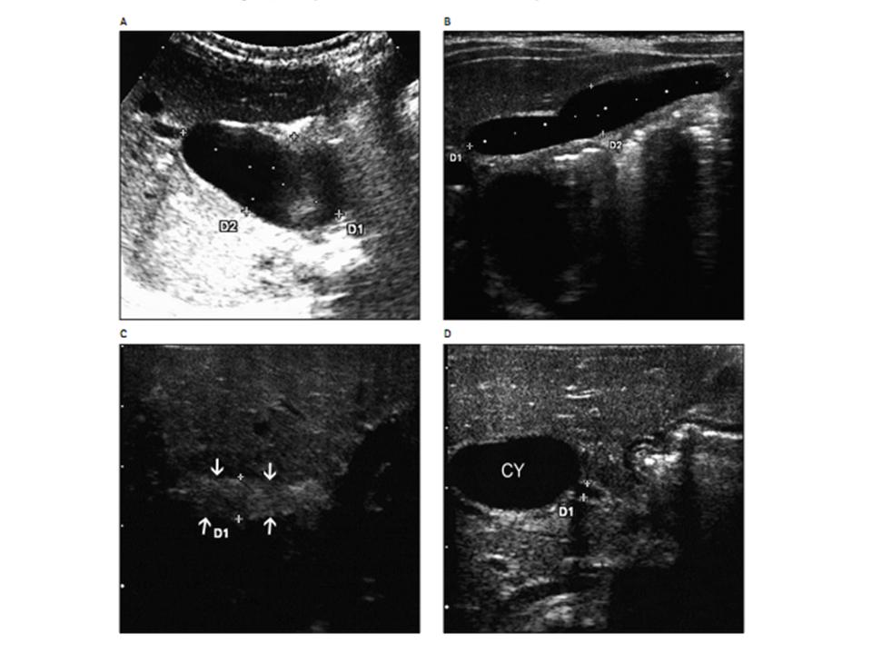 BÀI SOẠN VỀ SIÊU ÂM CHẨN ĐOÁN: Sonographic Findings of Cystic Biliary ...