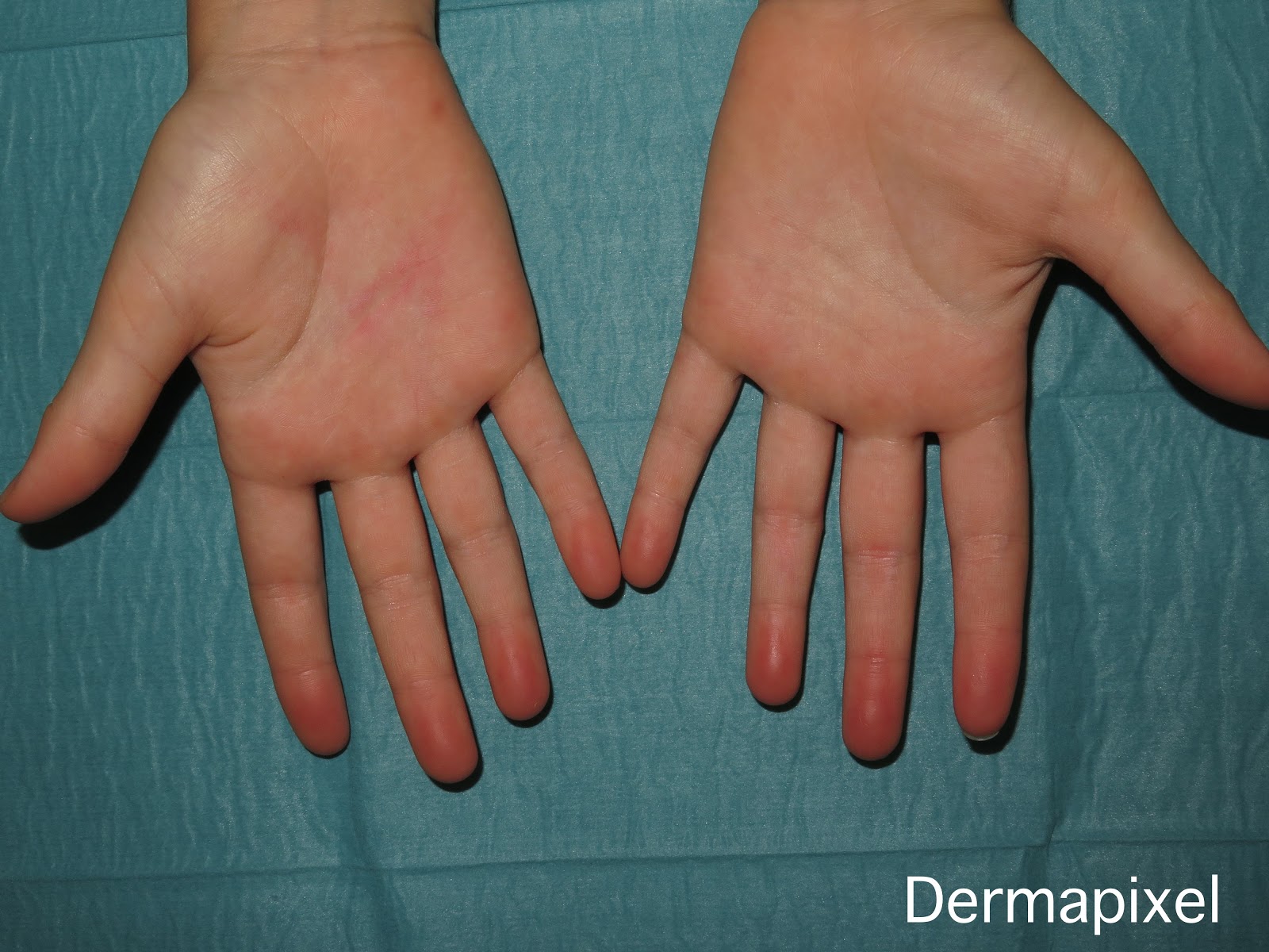 Dermapixel: La niña de los pulpejos rojos