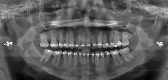 practical orthodontics: Bracket repositioning