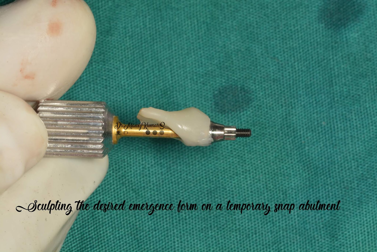 Case 1: Achieving the desired emergence profile - IMPLANT ESTHETICS