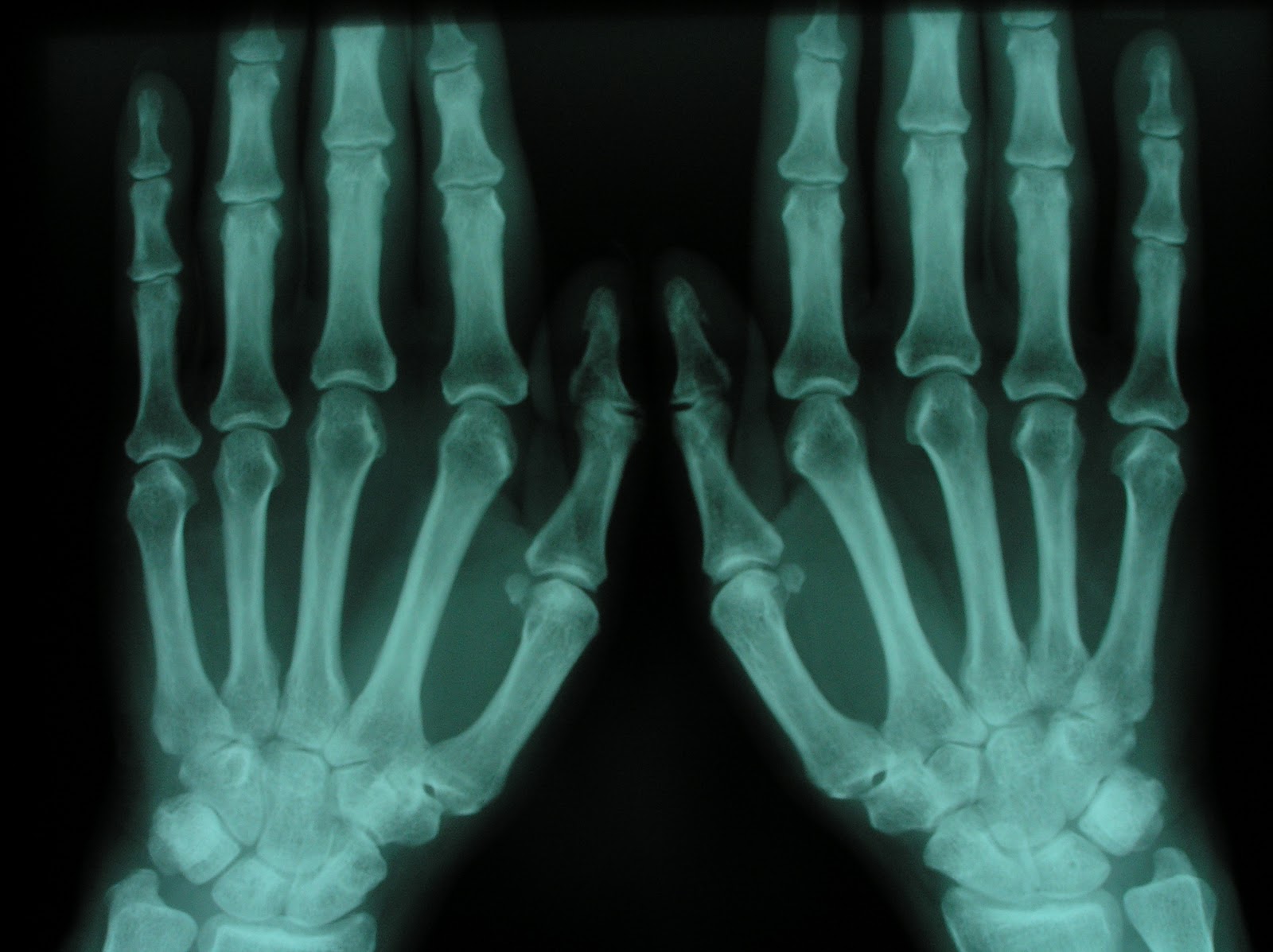 Rheumatologe: Arthrose / Definition, Diagnose und Dilemma