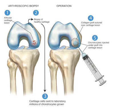 Megan's ACI Carticel Surgery: ACI Surgery Part II