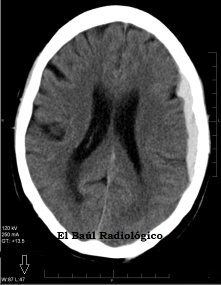 El Baúl Radiológico: NIVEL Y AMPLITUD DE VENTANA EN TOMOGRAFÍA ...