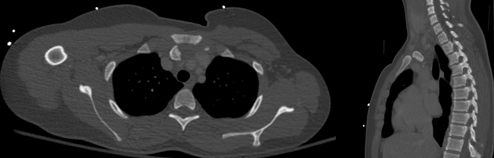 Roentgen Ray Reader: Posterior Dislocation of the Sternoclavicular Joint