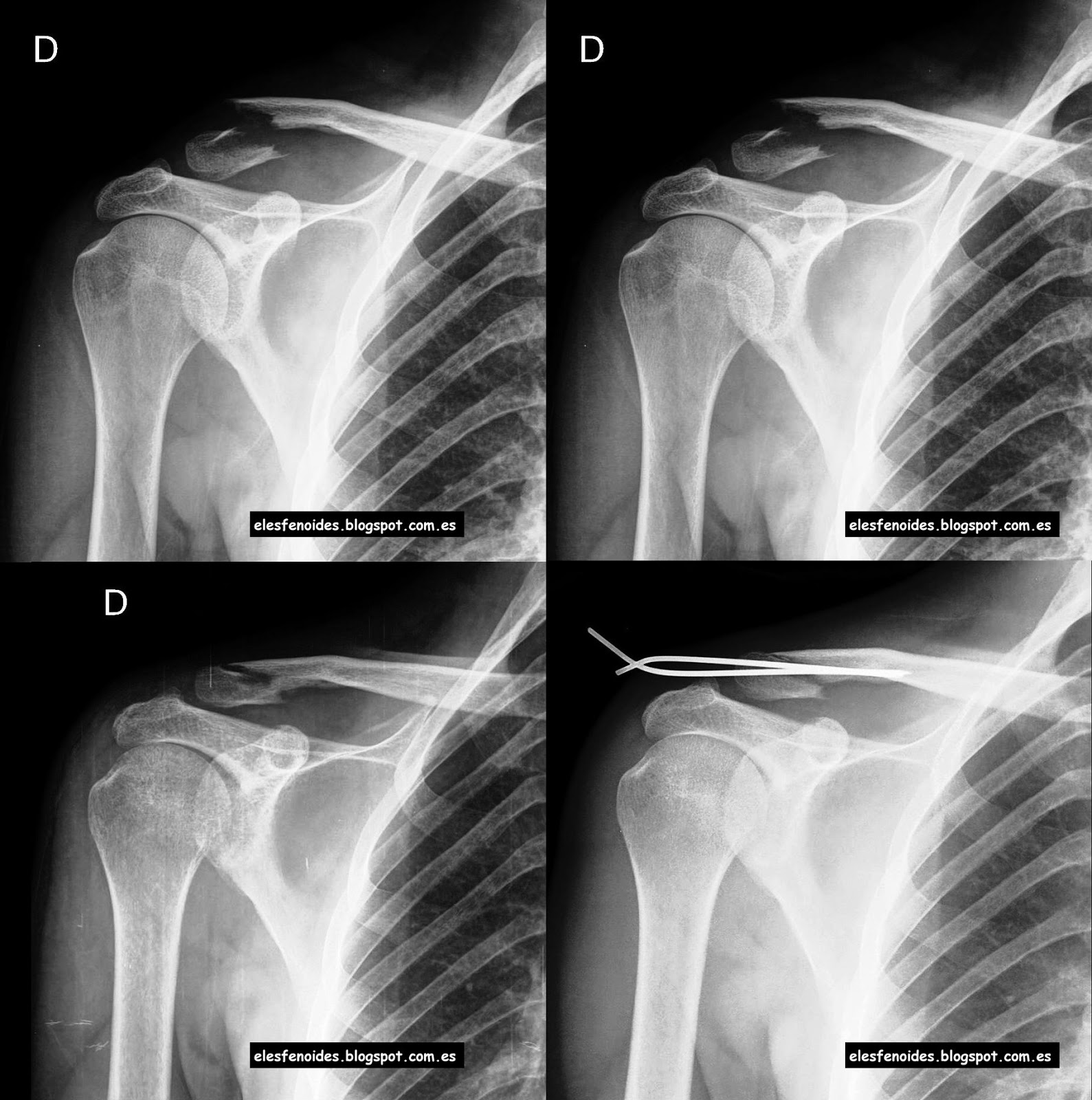Raio X De Clavícula Deslocada - BRAINCP