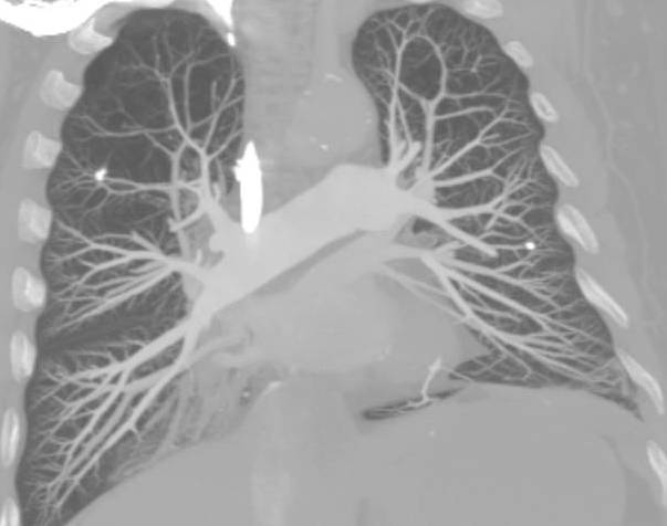 Pulmonary Angiography- Beautiful 128 Slice CT images - Sumer's ...