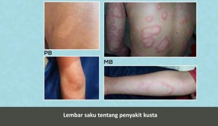 Potret Kusta di Indonesia : Pentingnya Kolaborasi Bersama SUKA untuk ...