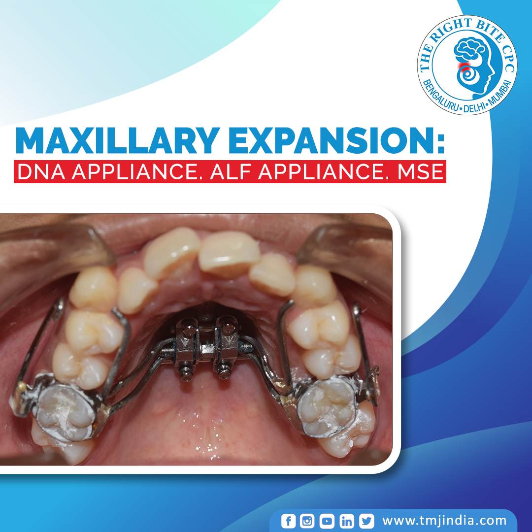 Treatment For TMJ Disorders: Maxillary Expansion: DNA appliance. ALF ...