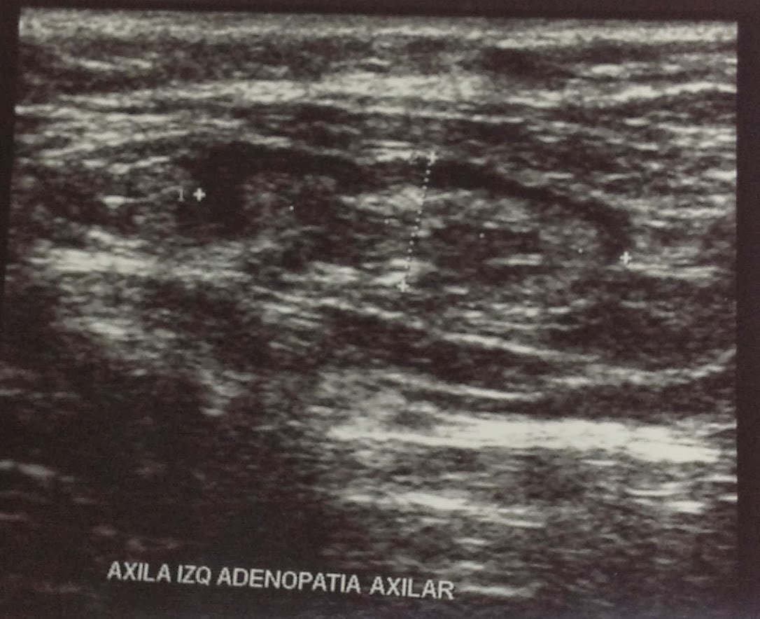 AUTOVACUNAS: Mastitis Infecciosa