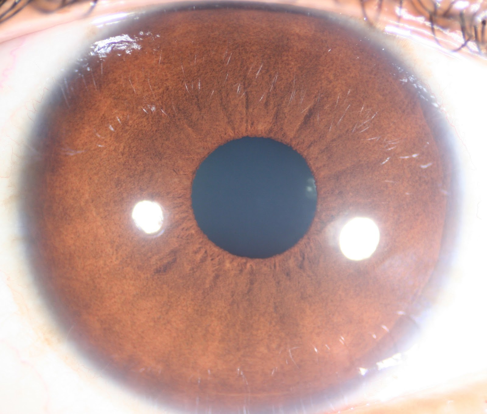 Modern & Multidimensional Iridology: Mammilations, Radial Furrows & The ...