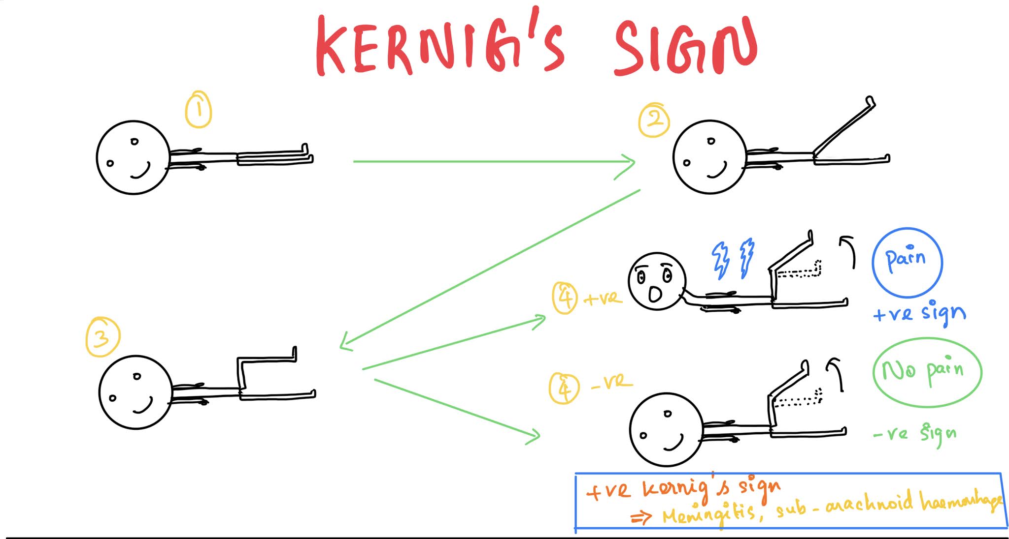 Medicograspers | Clinical signs in medicine | Kernig’s and brudzinki sign