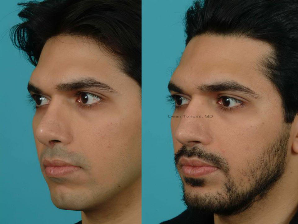 Dr. Dean Toriumi Reviews: Dean Toriumi Reviews: Nasal length restored ...