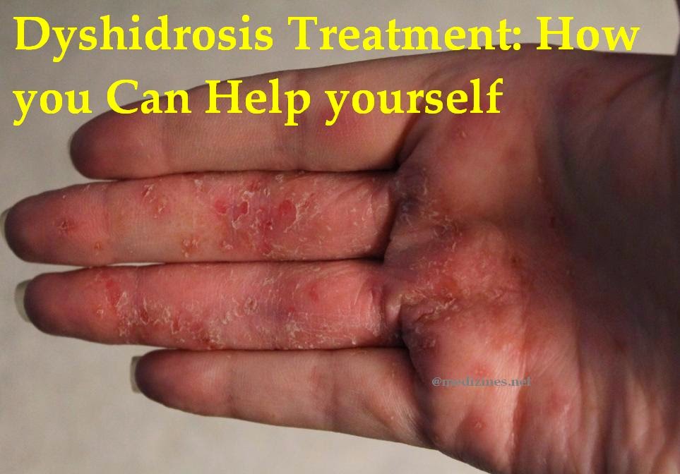 Dyshidrosis Treatment: How you Can Help yourself