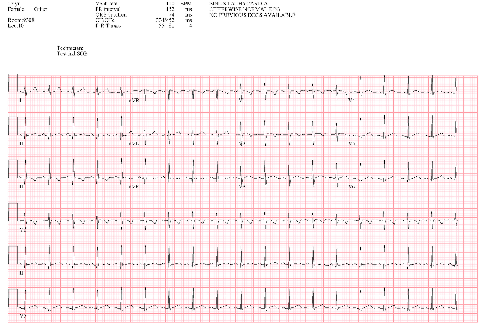Pedi cardiology: EKG: Pulmonary Embolism