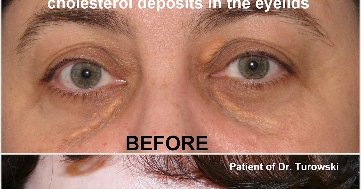 New Horizons Plastic Surgery: Xanthelasma Removal - Cholesterol ...
