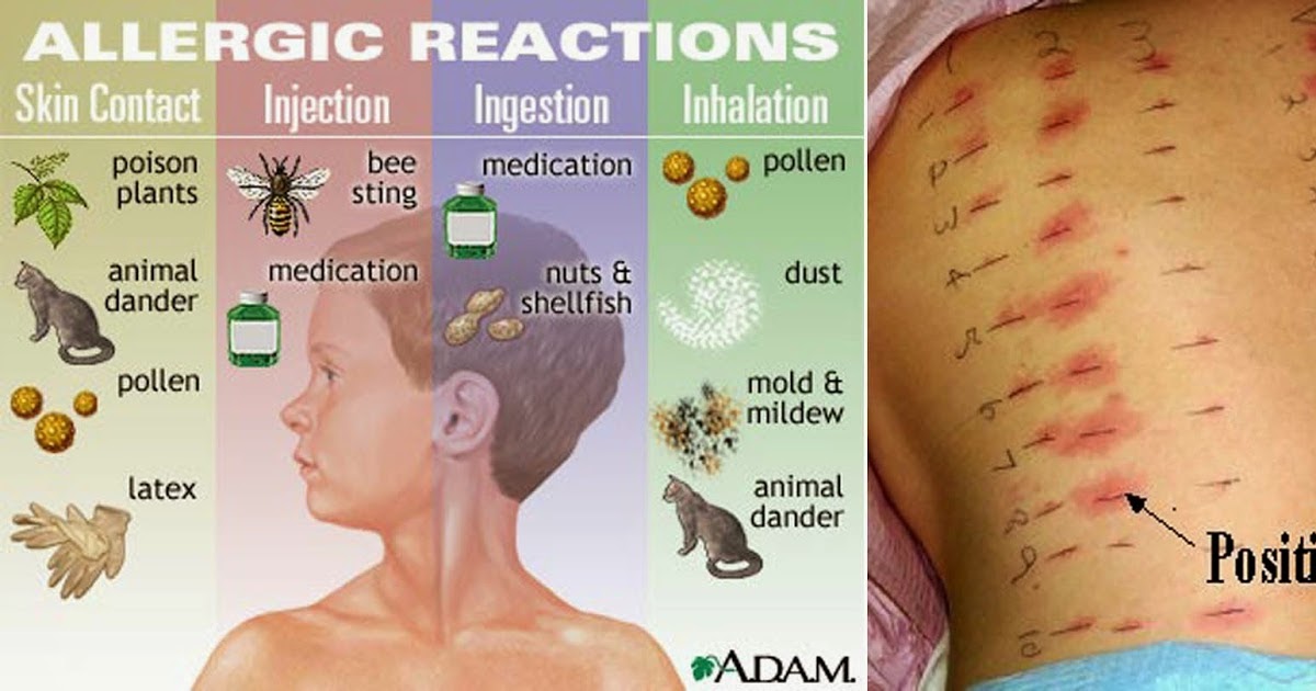 Allergies: Meaning, Symptoms, Causes, Management, And Treatment