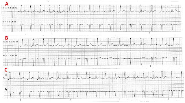 ECG Rhythms: WAP/MAR/MAT/Sinus arrhythmia