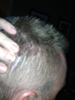 Trigeminal Cephalalgia Neuralgia aka Cluster Headache Suicide Headache ...