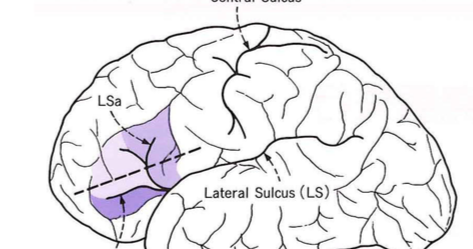 【言語表出の障害】 失語 構音障害 発話失行 aphasia, apraxia of speech, aphonia, aphemia ...