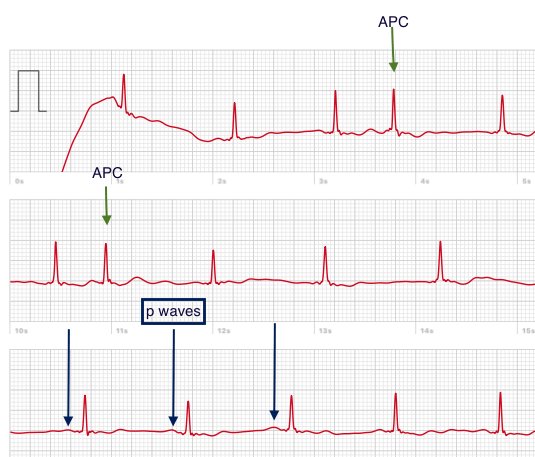 Premature Atrial Complexes (PAC) - Dasherfa