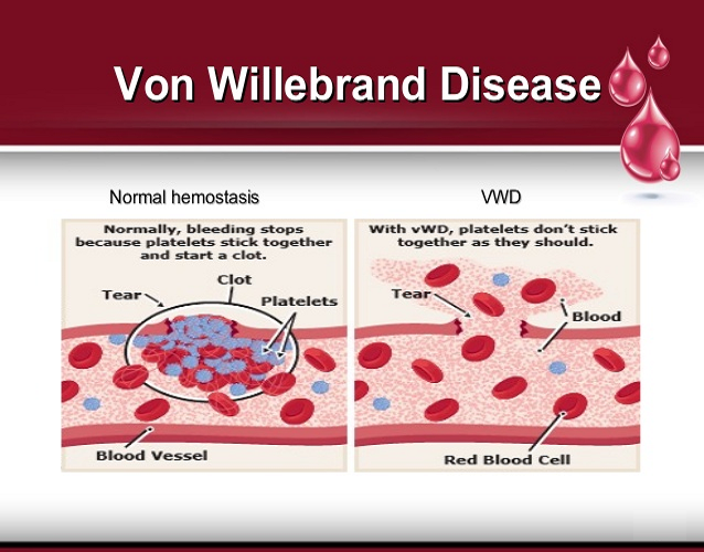The Health Hub: Von Willebrand disease