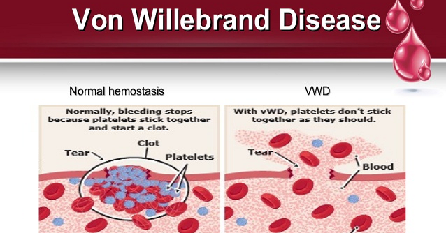 The Health Hub: Von Willebrand disease