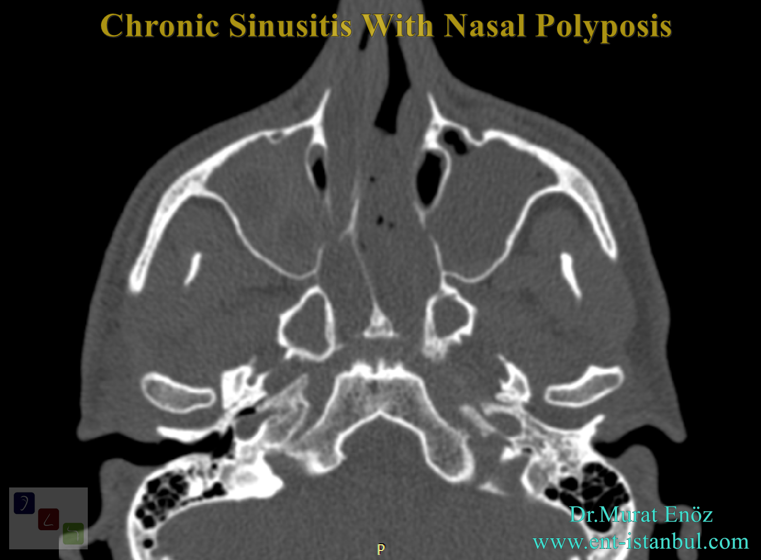 Health Zone Turkey: In Which Situations Is Paranasal Sinus Tomography ...