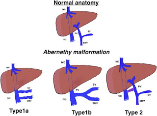 Pedi cardiology: Abernathy Syndrome