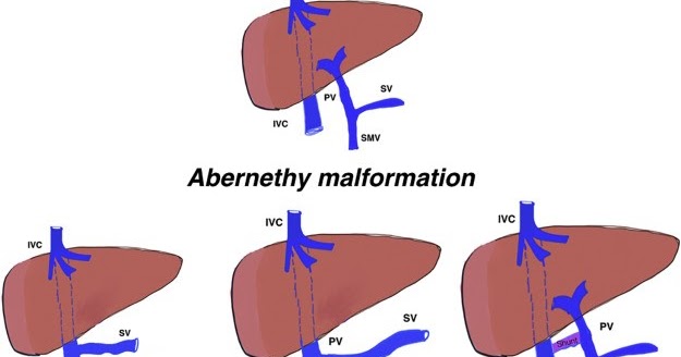 Pedi cardiology: Abernathy Syndrome
