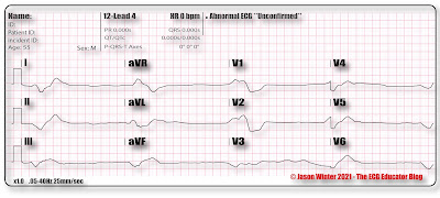 ECG Educator Blog : Agonal Rhythm