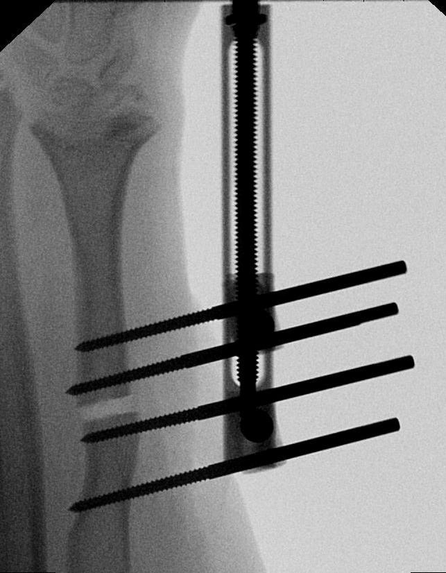 Fixators for Lengthening. Fun? | Congenital Hand and Arm Differences ...