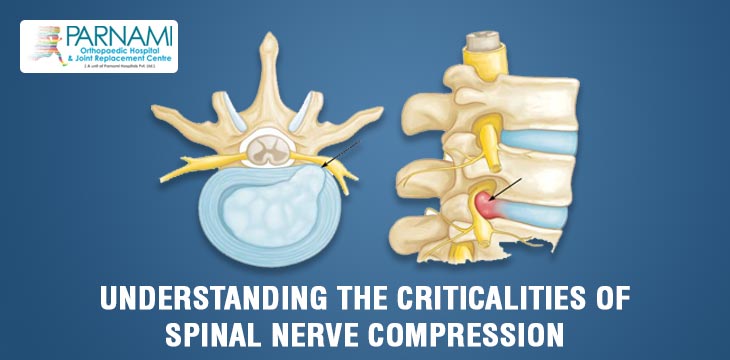 Understanding The Criticalities Of Spinal Nerve Compression