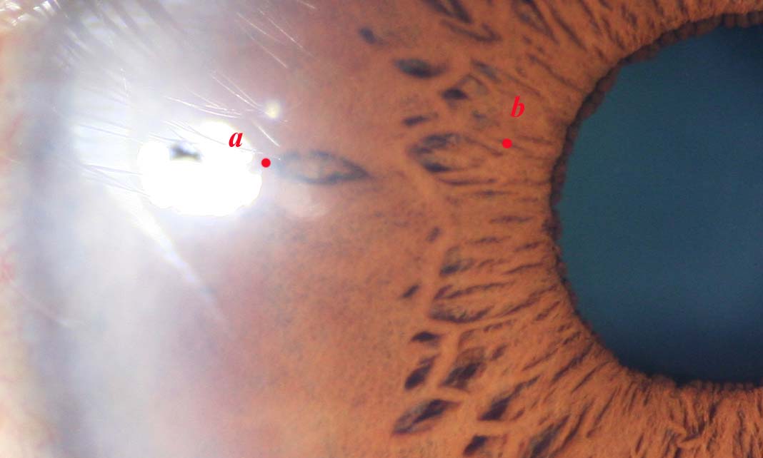 Modern & Multidimensional Iridology: Lacunae at Ciliary & Pupillary ...