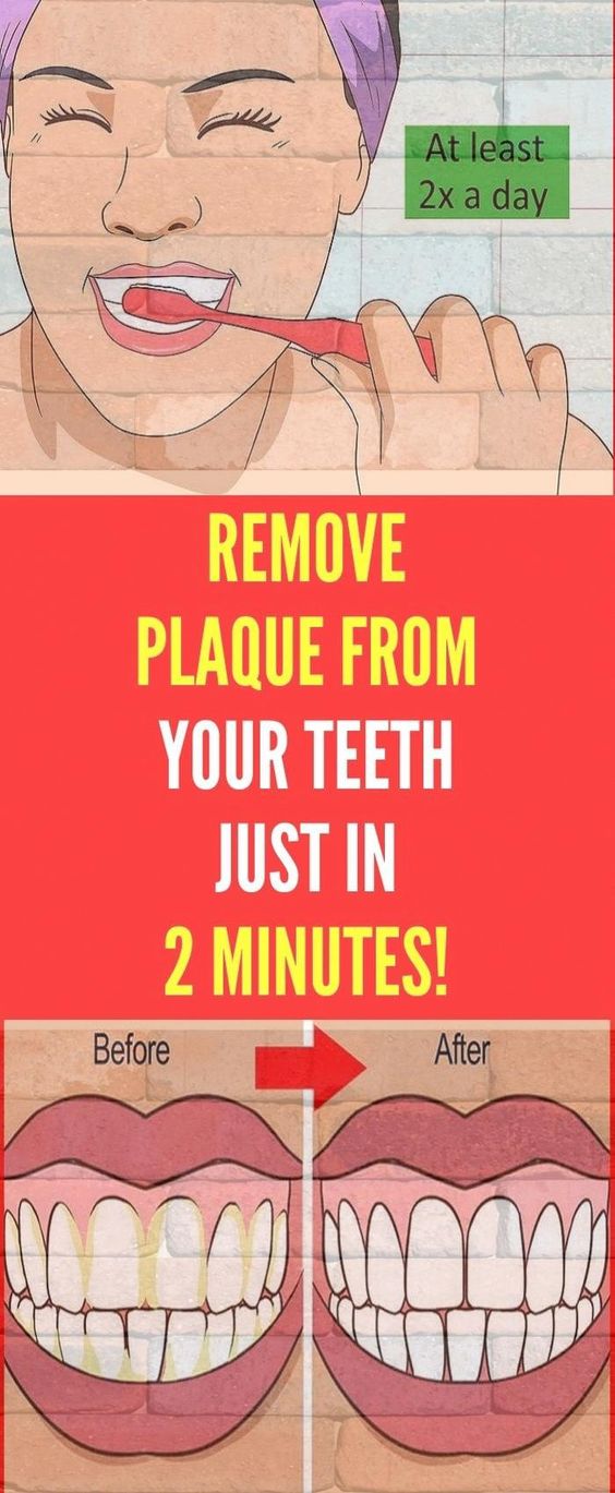 Remove Stubborn Plaque From Your Teeth in Just 2 Minutes Flat ...