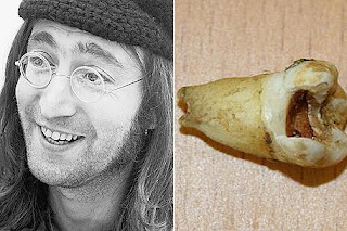 Periodontal Associates - Dental Implant Team : John Lennon's Chomper
