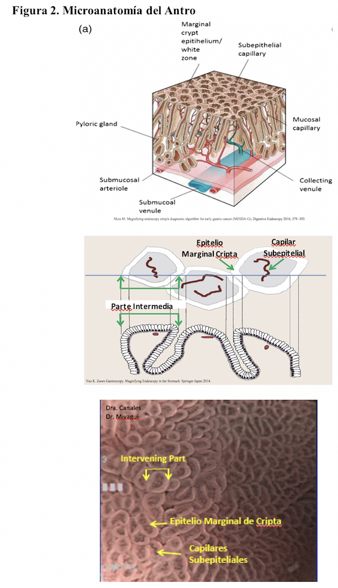 Gastroenterología Clínica Delgado: DIAGNÓSTICO DIFERENCIAL DE TUMORES ...