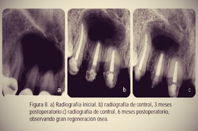 PDF: Lesión periapical persistente: caso clínico - Odontología Virtual