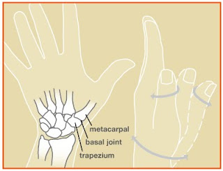 handctr: Arthritis of the Thumb and Wrist