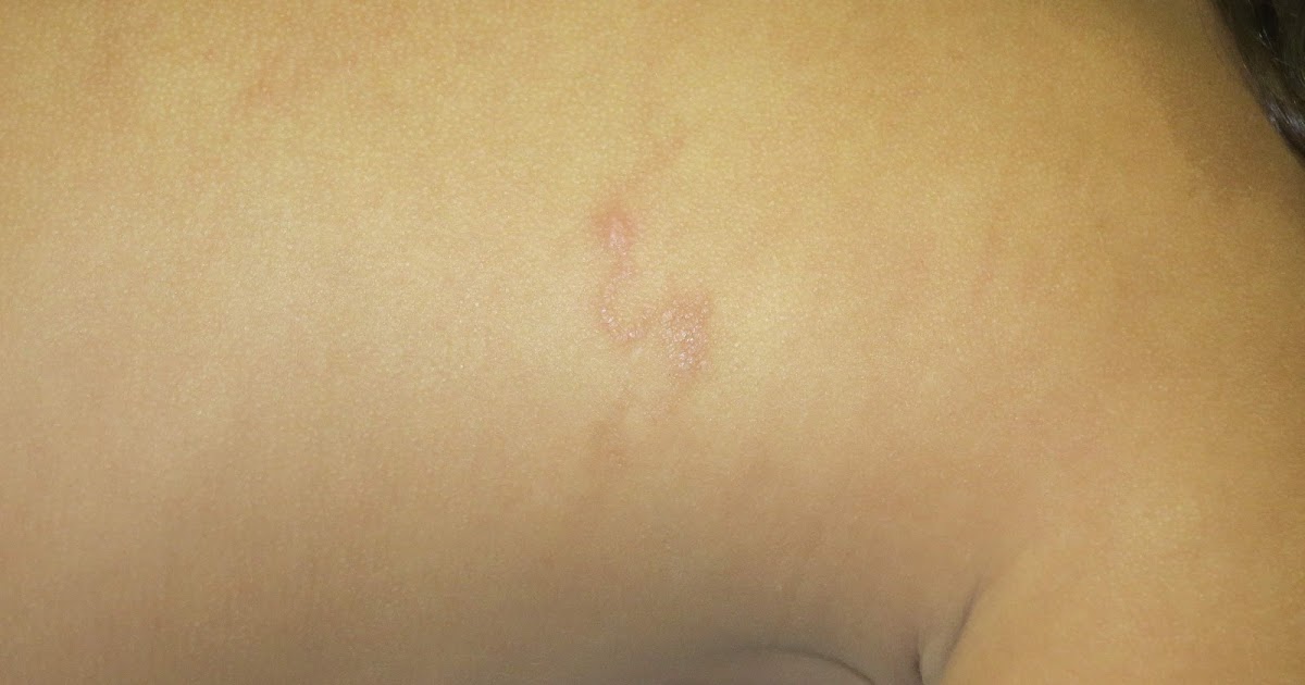 Dermapixel: Larva migrans en niños: ¿cómo se trata?