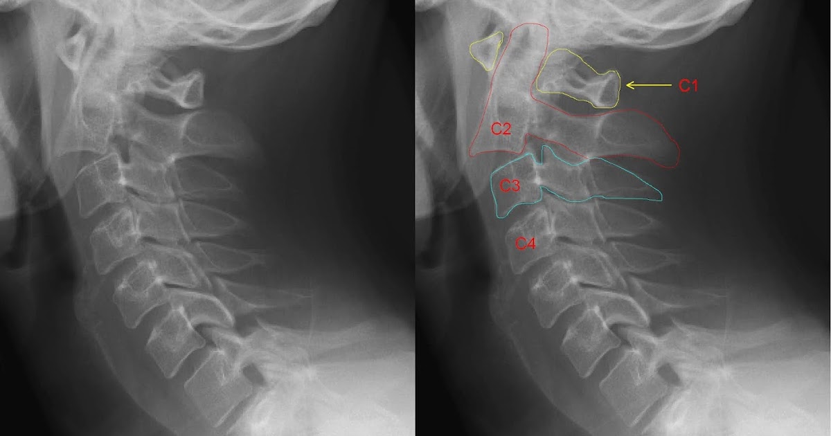 Spine Fracture Treatment | Spine Bone Fracture Surgery