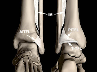 MRI Musculo-Skeletal Section: High ankle sprains.
