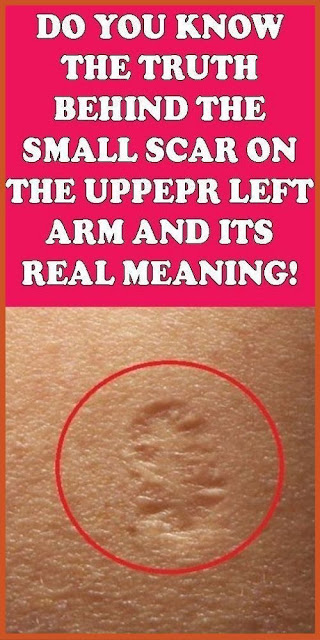 Do You Know The Truth Behind The Small Scar On The Upper Left Arm And ...