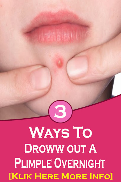 How To Draw Out A Pimple Overnight - cforbes2.blogspot.com