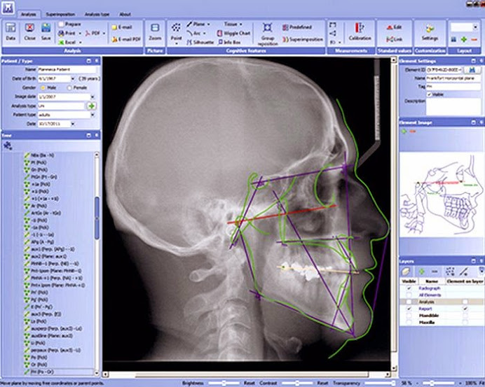 DENTAL SOFTWARE: Planmeca Romexis Cephalometric Analysis module