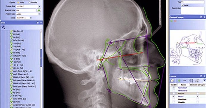 DENTAL SOFTWARE: Planmeca Romexis Cephalometric Analysis module - Odonto-Tv