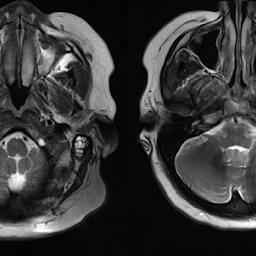 Cochlear implants and MRI safety