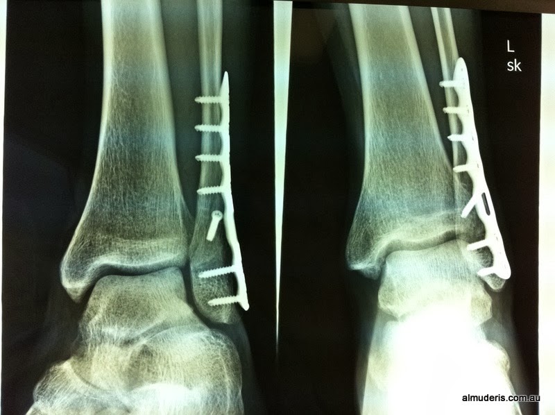 hEiDiMatEs - MeDICinE: General principle of management for open fracture