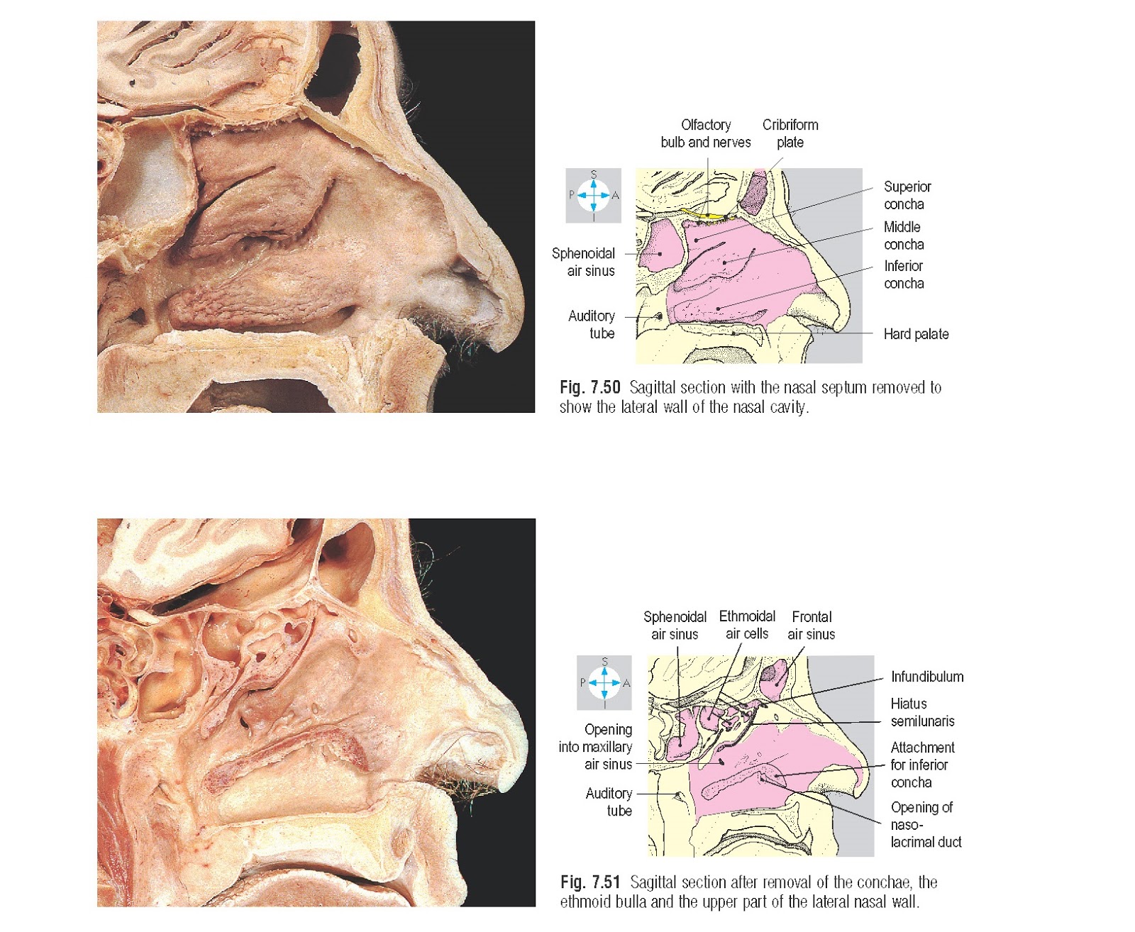 Nasal Cavities and Paranasal Air Sinuses Anatomy - pediagenosis