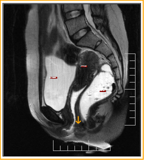 Rectovaginal Fistula MRI - Sumer's Radiology Blog