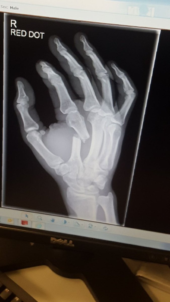 Boxing Hand Injuries at Michael Brehm blog